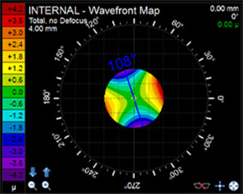 How the Toric Alignment Check Works | iTrace Technologies