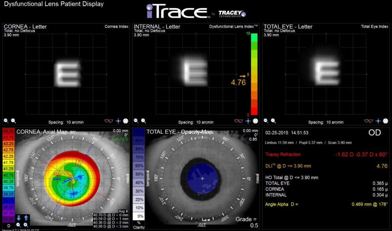 Why iTrace Autorefractor & Keratometer? | Tracey Technologies